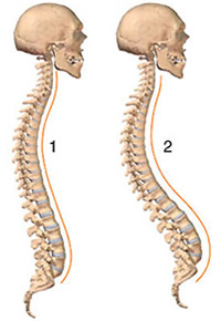Deformacije kralježnice - kifoza i lordoza | Fitness.com.hr