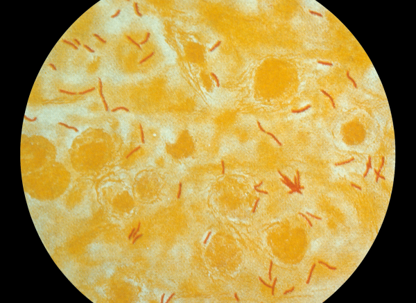 Bolesti pluća tuberkuloza - simptomi, uzroci i liječenje | Fitness.com.hr