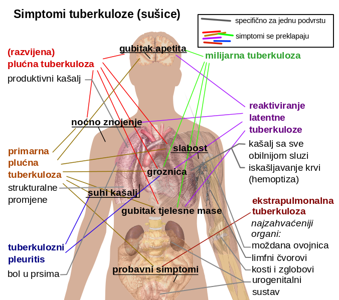 Bolesti pluća tuberkuloza - simptomi, uzroci i liječenje | Fitness.com.hr