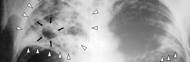 Bolesti pluća tuberkuloza - simptomi, uzroci i liječenje | Fitness.com.hr